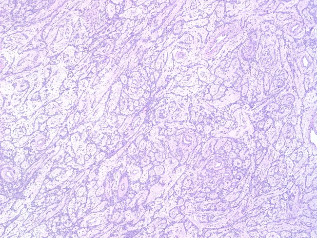 Epithelioid Leiomyoma (Plexiform-type) of Uterus