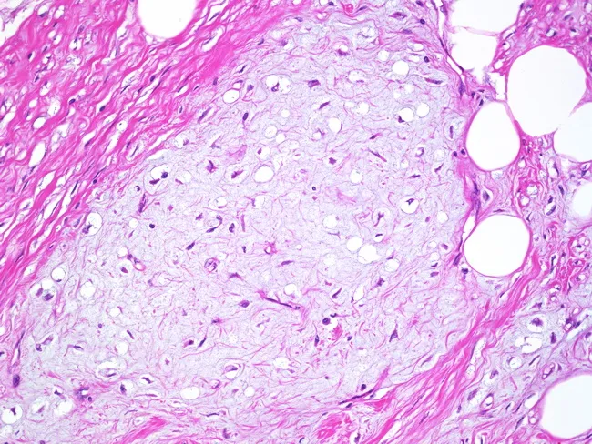 Lipoleiomyoma of Uterus with Chondroid Metaplasia