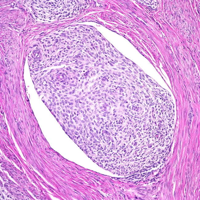 Endometrial Stromal Sarcoma showing Vascular Invasion