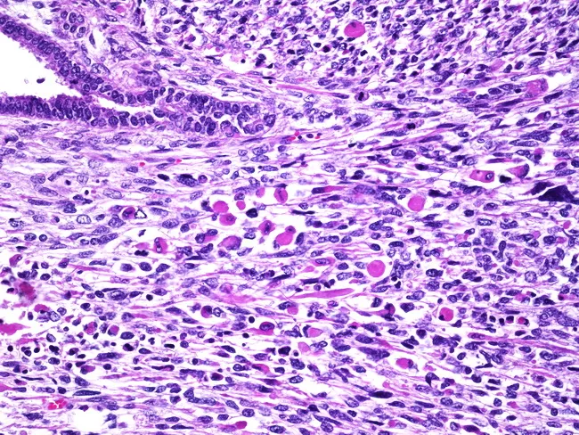 Malignant Mixed Mullerian Tumor (Carcinosarcoma)