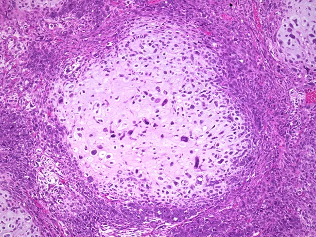 Malignant Mixed Mullerian Tumor (Carcinosarcoma)