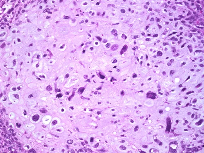Malignant Mixed Mullerian Tumor (Carcinosarcoma)