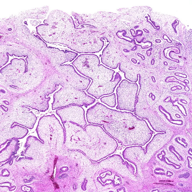 Mullerian Adenosarcoma
