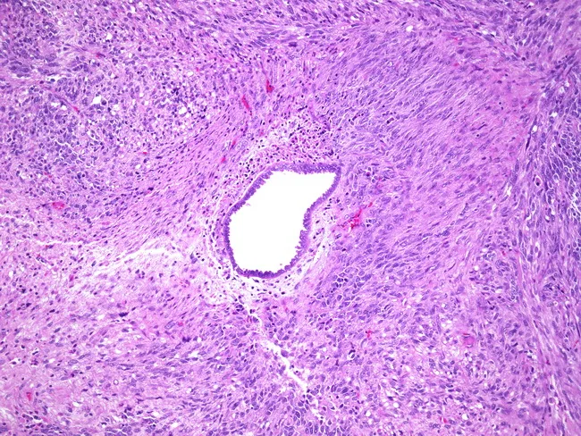 Mullerian Adenosarcoma with Sarcomatous Overgrowth