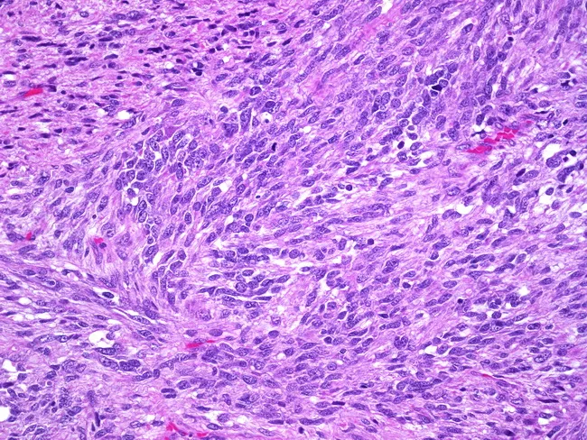 Mullerian Adenosarcoma with Sarcomatous Overgrowth