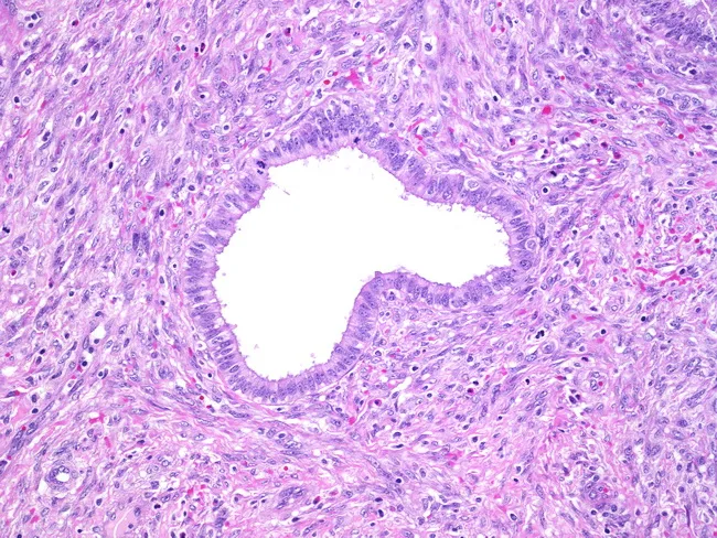 Mullerian Adenosarcoma