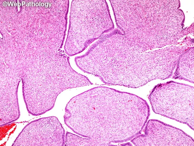 Mullerian Adenosarcoma