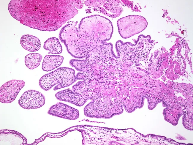 Adenofibroma of Uterus