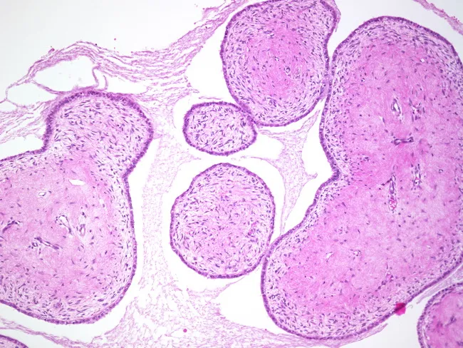 Adenofibroma of Uterus