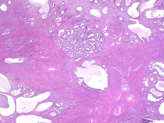 Atypical Polypoid Adenomyoma