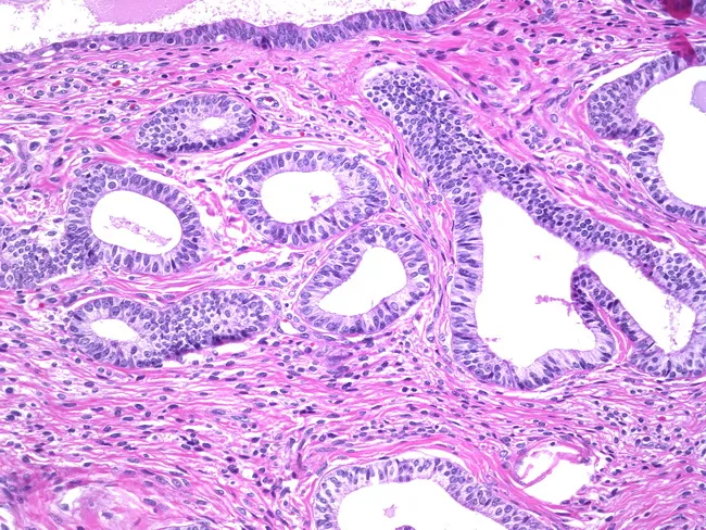 Atypical Polypoid Adenomyoma