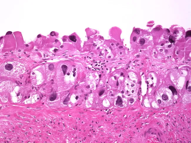 Large Solitary Luteinized Follicle Cyst of Pregnancy