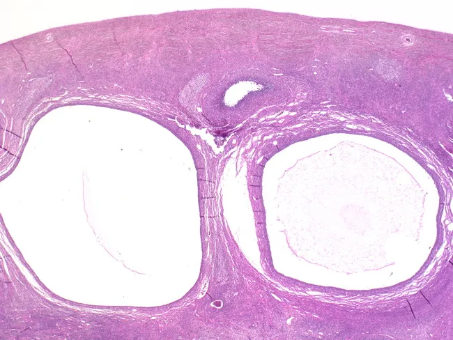 Polycystic Ovary Disease (Stein-Leventhal Syndrome)