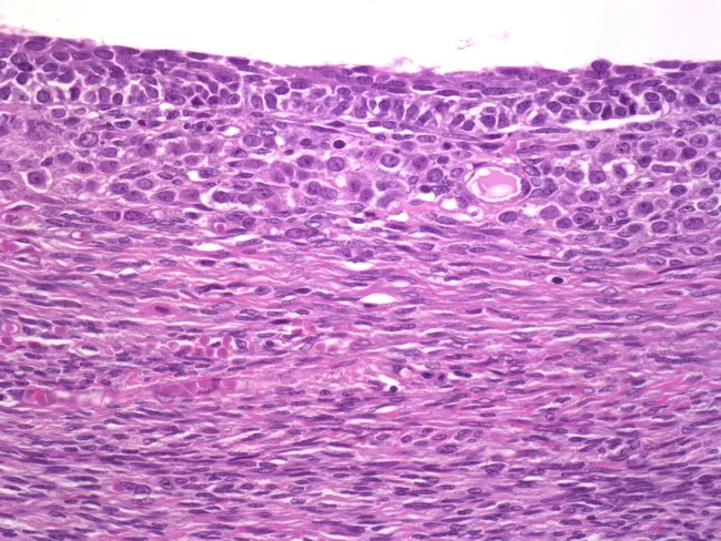 Polycystic Ovary Disease (Stein-Leventhal Syndrome)