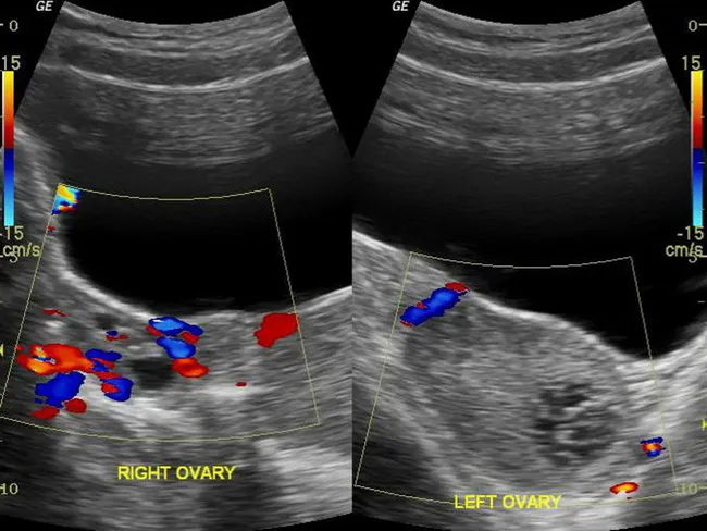 Ovarian Torsion : Doppler Ultrasound