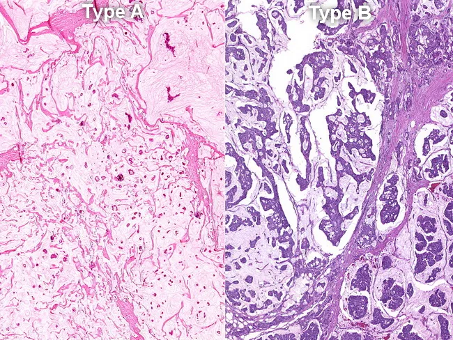 Mucinous Carcinoma of Breast : Types A and B