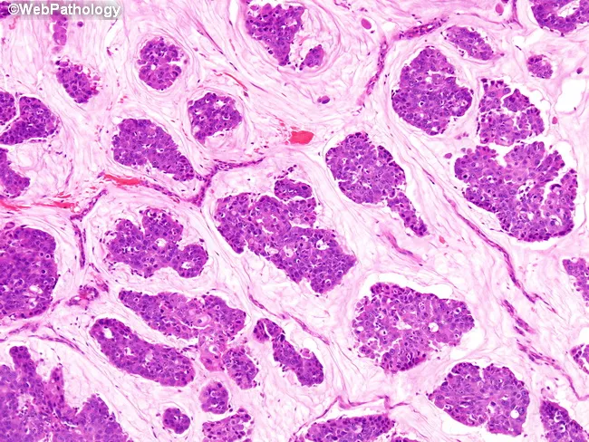 Mucinous Carcinoma of Breast : Immunostains