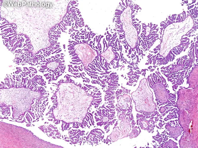 Low-grade Serous Carcinoma