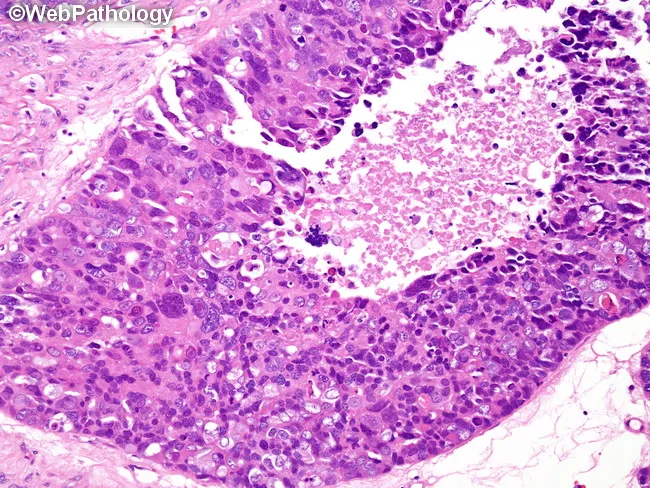 High-grade Serous Carcinoma