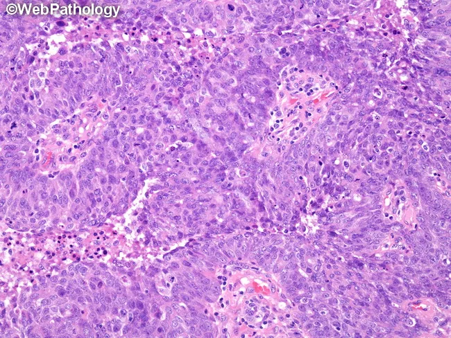 High-grade Serous Carcinoma