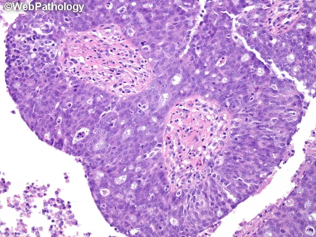 High-grade Serous Carcinoma