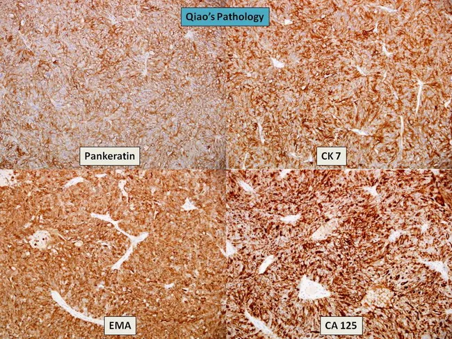 High-grade Serous Carcinoma : Immunostains