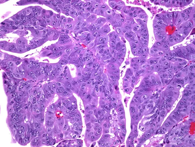 Mucinous Carcinoma : Differential Diagnosis
