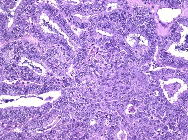 Endometrioid Carcinoma with Squamous Metaplasia