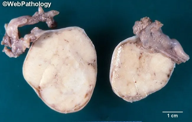 Benign Brenner Tumor : Gross