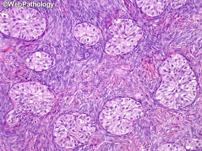 Benign Brenner Tumor