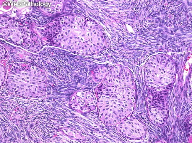 Benign Brenner Tumor