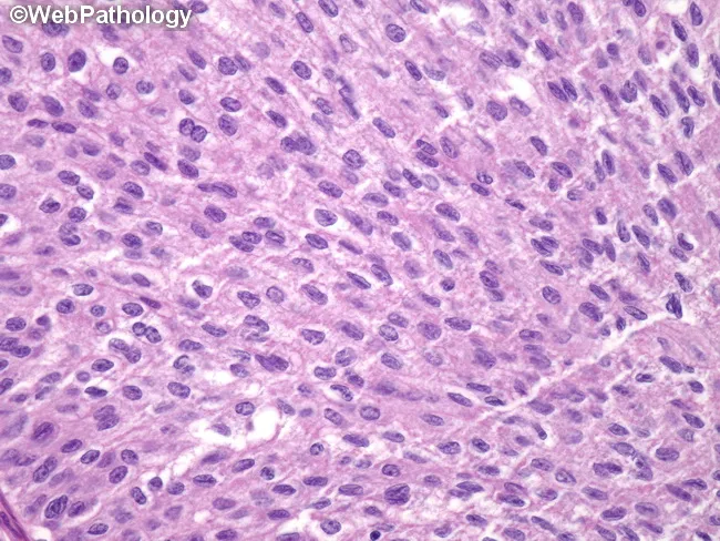 Borderline Brenner Tumor