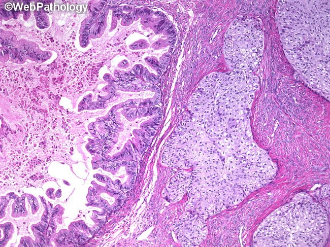 Borderline Brenner Tumor with Mucinous Borderline Tumor