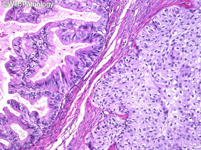 Borderline Brenner Tumor with Mucinous Borderline Tumor
