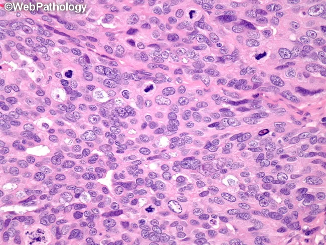 Malignant Brenner Tumor : Differential