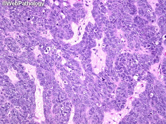 Malignant Brenner Tumor