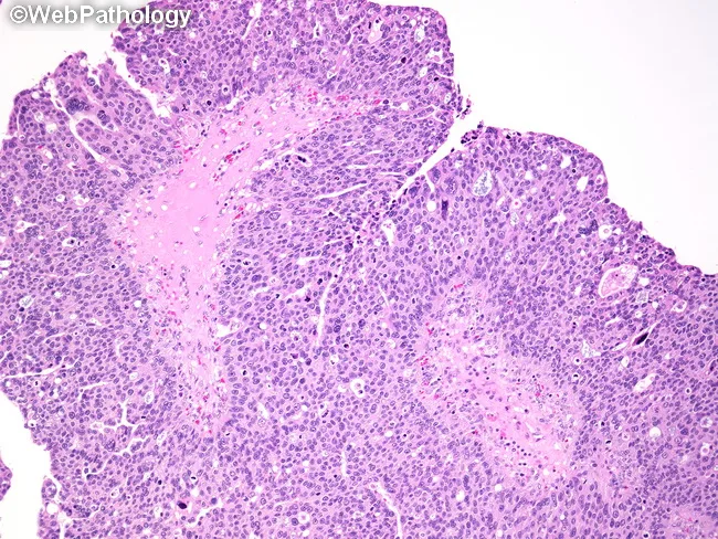 Transitional Cell Carcinoma Assessment Of Tumor Associated Tissue