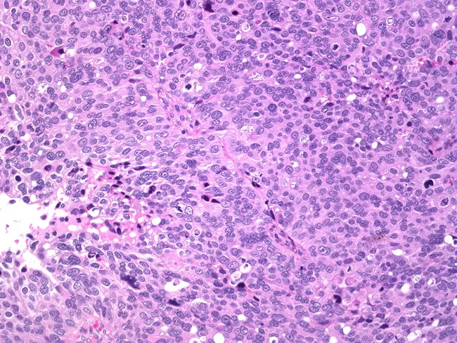 Transitional Cell Carcinoma of Ovary