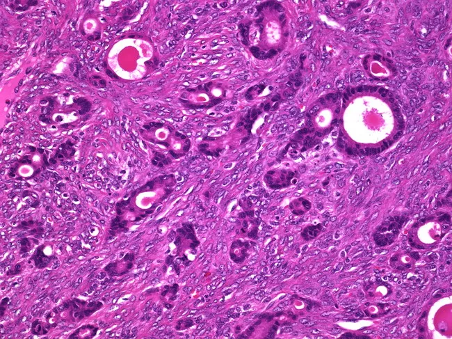 Malignant Mixed Mullerian Tumor (MMMT)