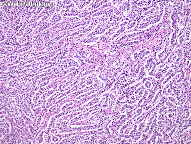 Dysgerminoma : Microscopic