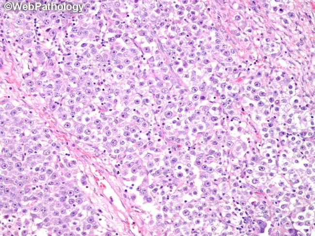 Dysgerminoma : Differential Diagnosis