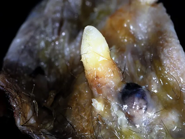 Mature Cystic Teratoma : Clinical Features