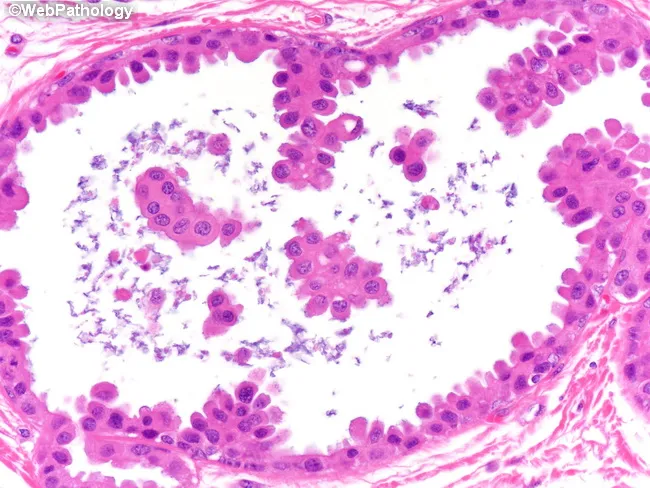 Apocrine DCIS