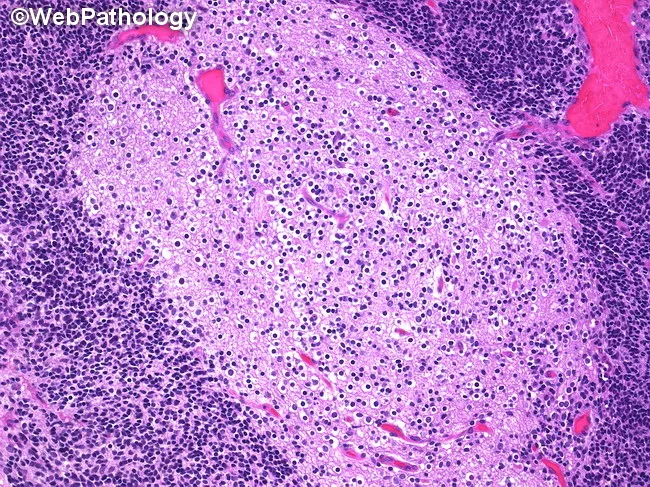 Immature Teratoma : Microscopic