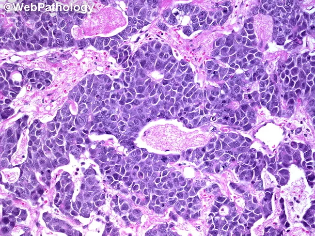 Embryonal Carcinoma : Introduction