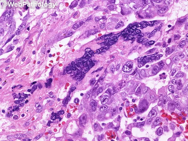 Embryonal Carcinoma : Microscopic Features