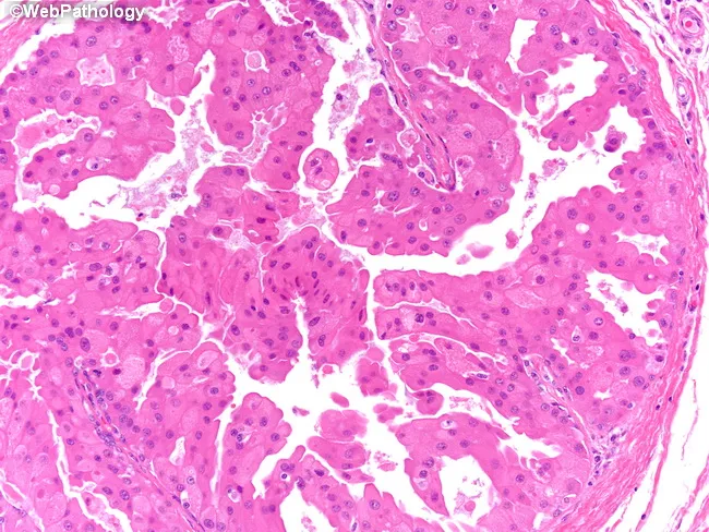 Apocrine DCIS