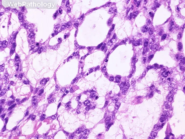 Yolk Sac Tumor : Cellular Features