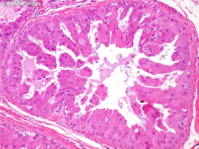 Apocrine DCIS