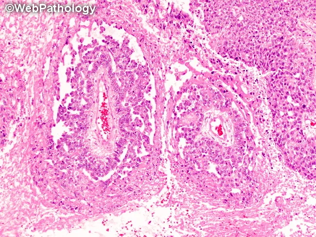 Yolk Sac Tumor : Schiller-Duval Body